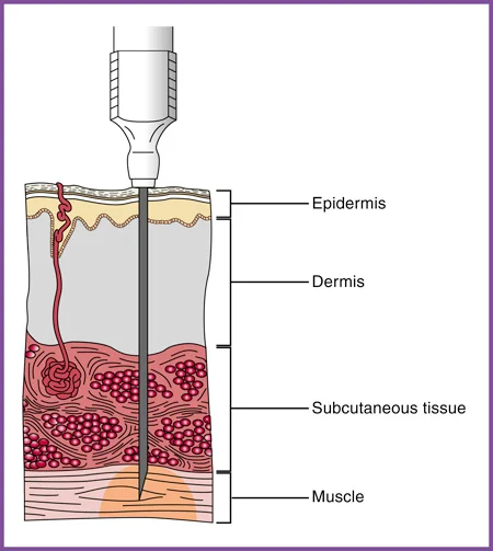 Intramuscular Injections – Learn HCIS – LVN and MA Certification