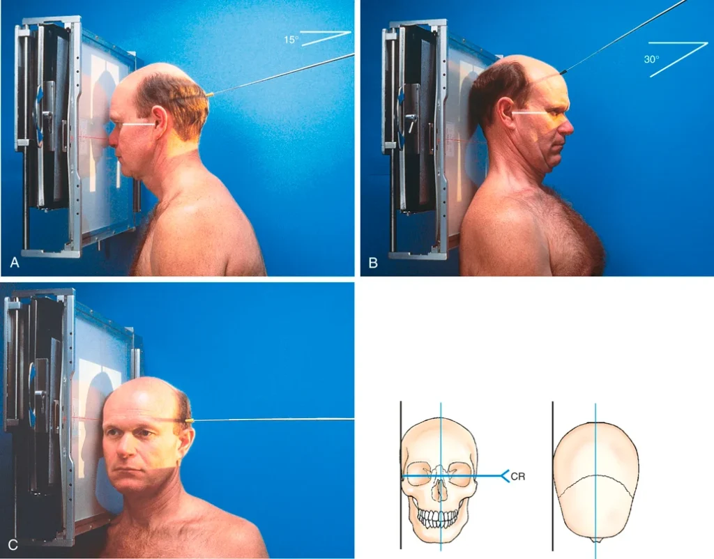 Skull, Facial Bones, and Paranasal Sinuses – Learn HCIS – LVN and MA ...